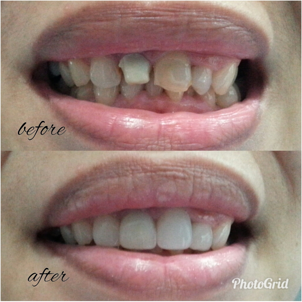 Tampalan sewarna Gigi: Dr Nik – Klinik Pergigian Fauziah