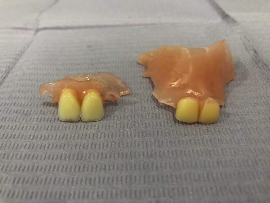 Valplast Denture to Replace Old Acrylic Denture – Dr Gwen Gan – Klinik ...