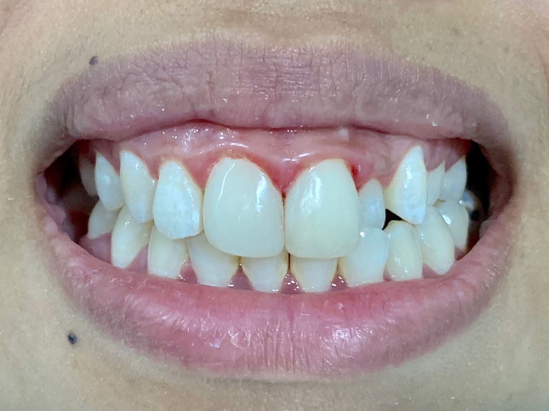 The Not-so-pretty Fluorosis – Dr. Adyan – Klinik Pergigian Fauziah