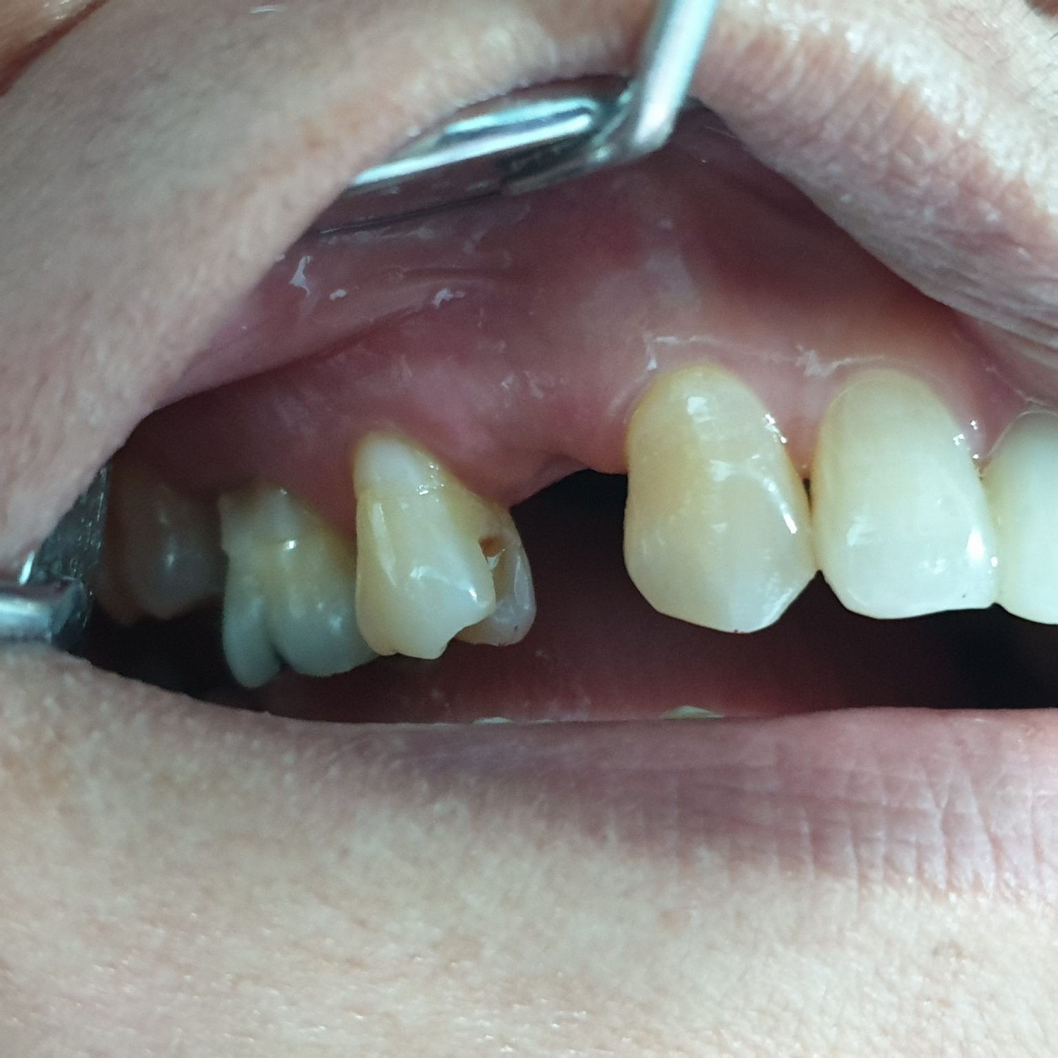 FRC Bridge, again! – Dr. Nik – Klinik Pergigian Fauziah