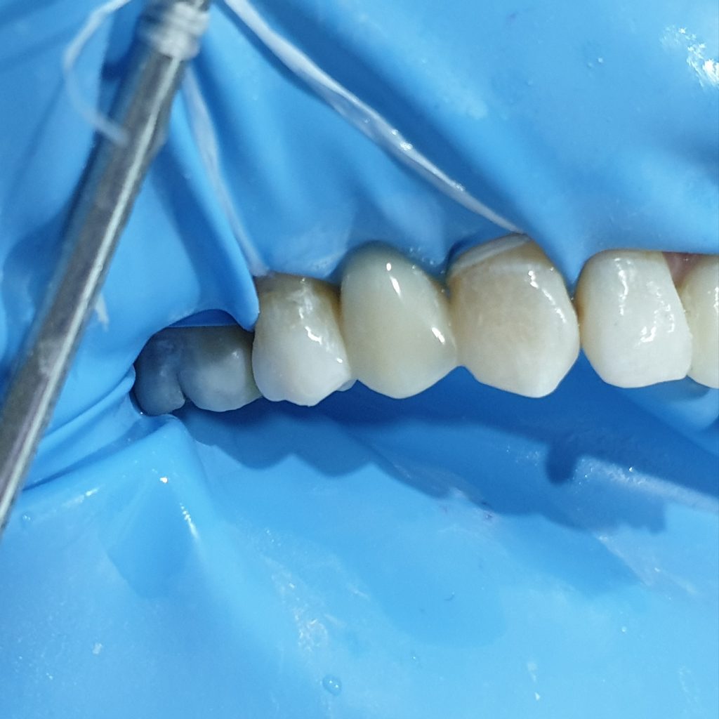 FRC Bridge, again! – Dr. Nik – Klinik Pergigian Fauziah