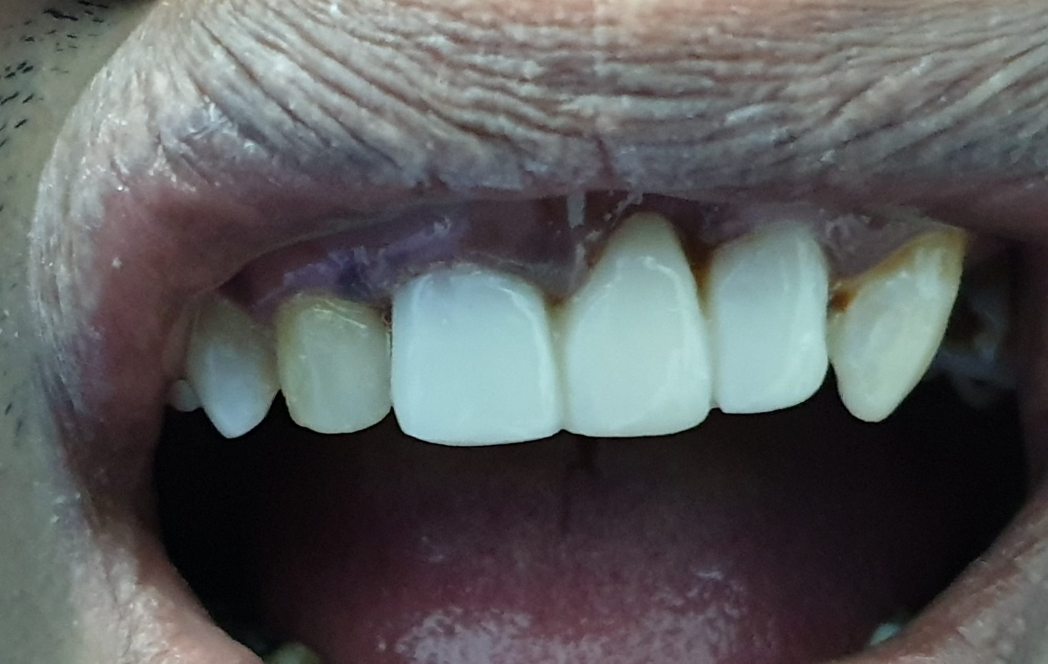 Replacing missing tooth with FRC bridge: Dr Nik – Klinik Pergigian Fauziah