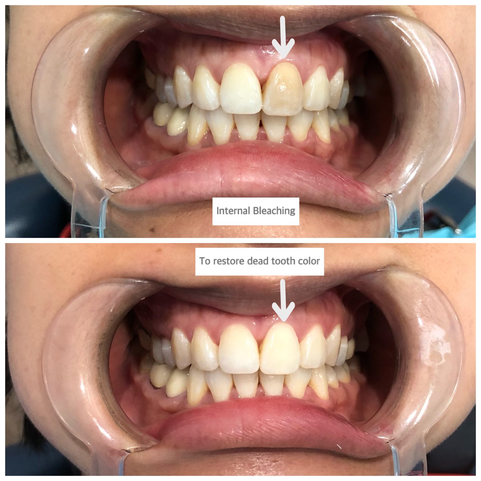 A Single Tooth Whitening with Internal Bleaching – Dr. Gwen Gan ...