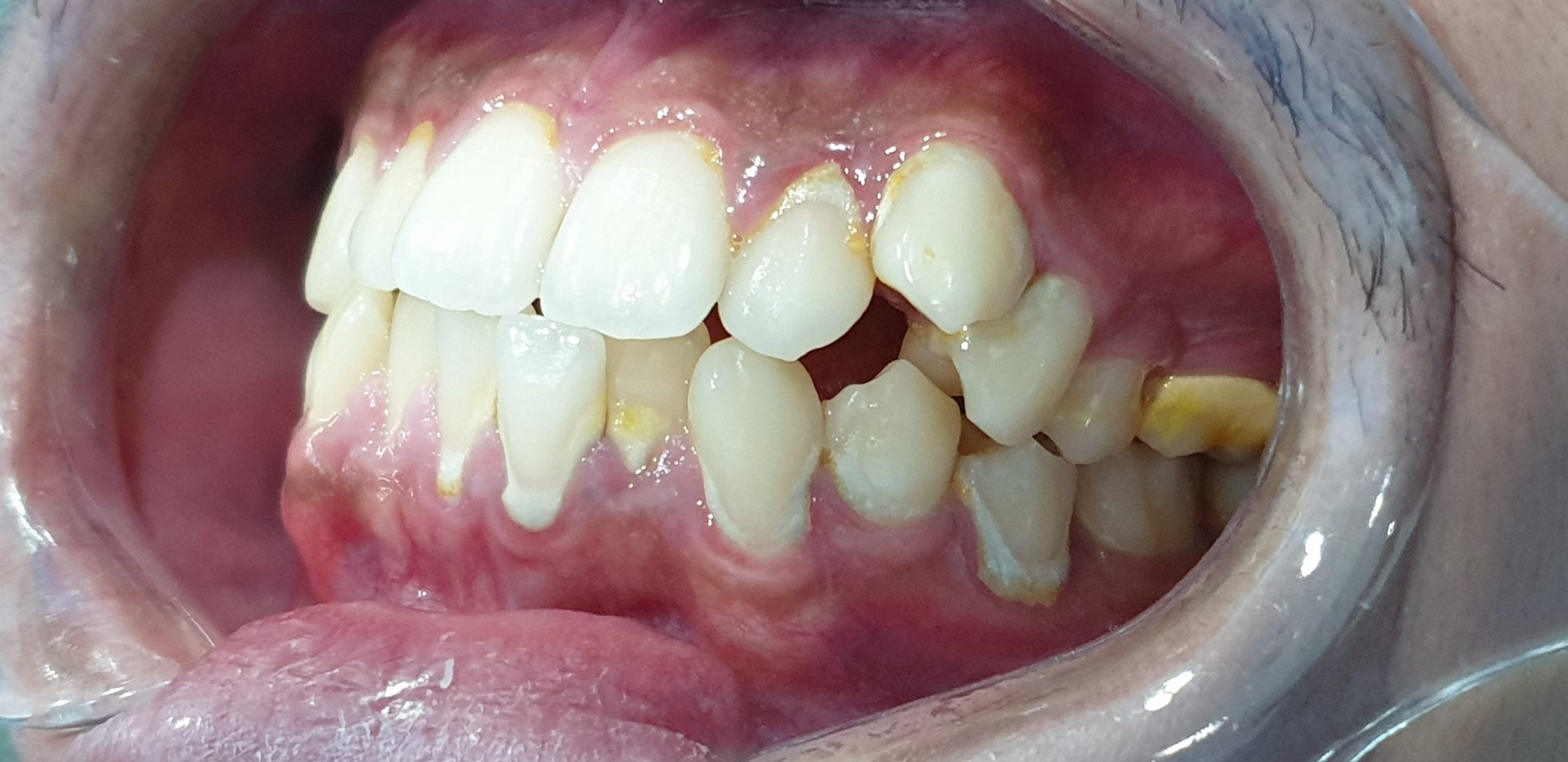 Dental Scaling: Dr Nik – Klinik Pergigian Fauziah