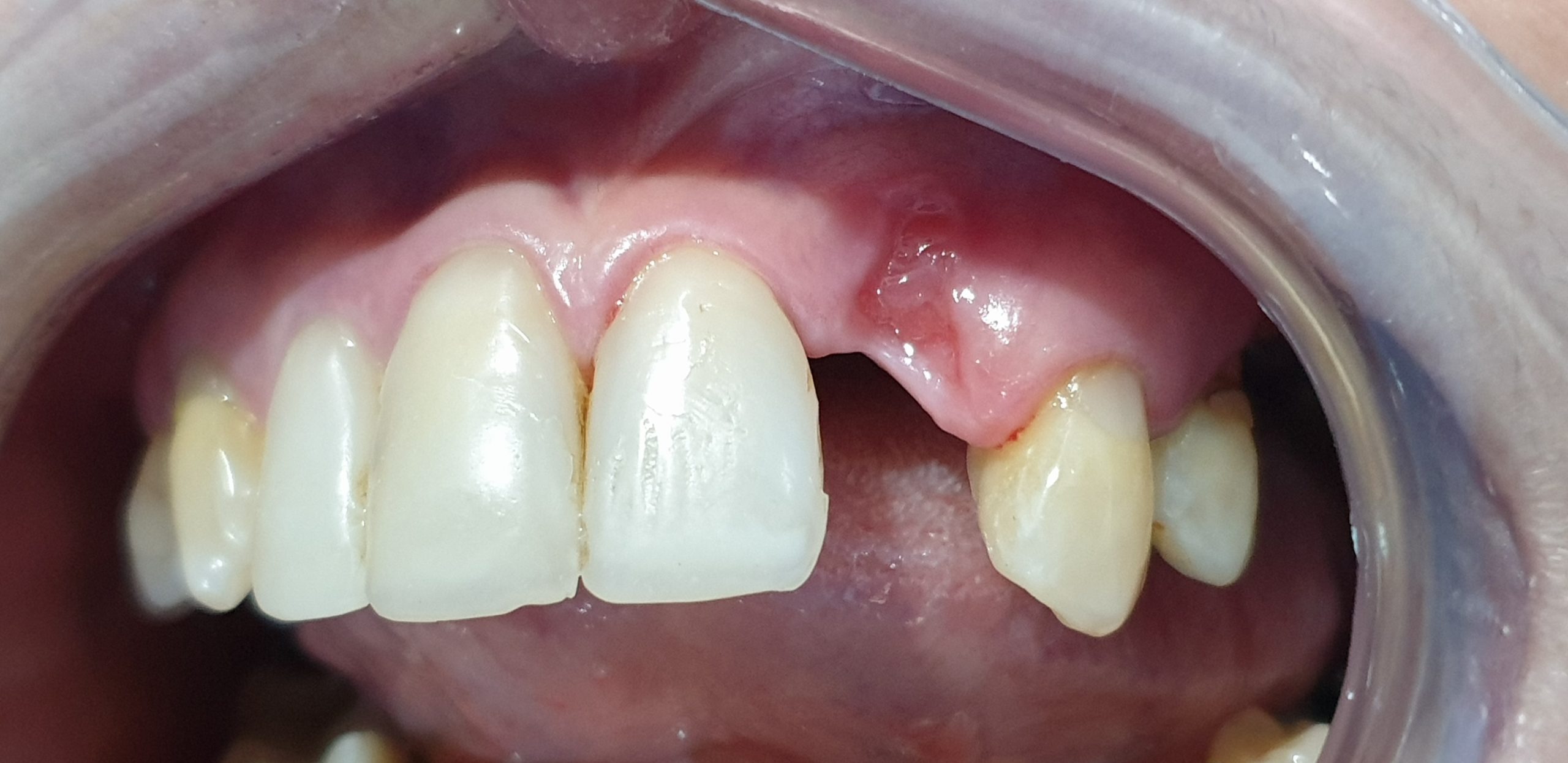 From denture to FRC bridge: Dr Nik – Klinik Pergigian Fauziah