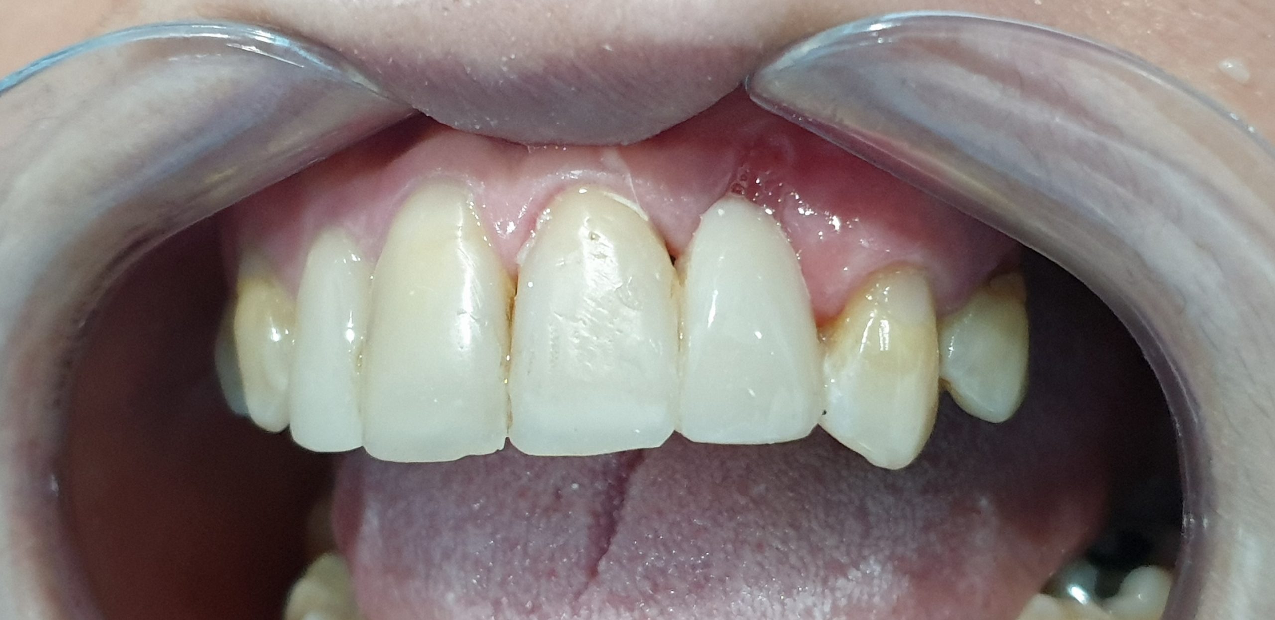 From denture to FRC bridge: Dr Nik – Klinik Pergigian Fauziah