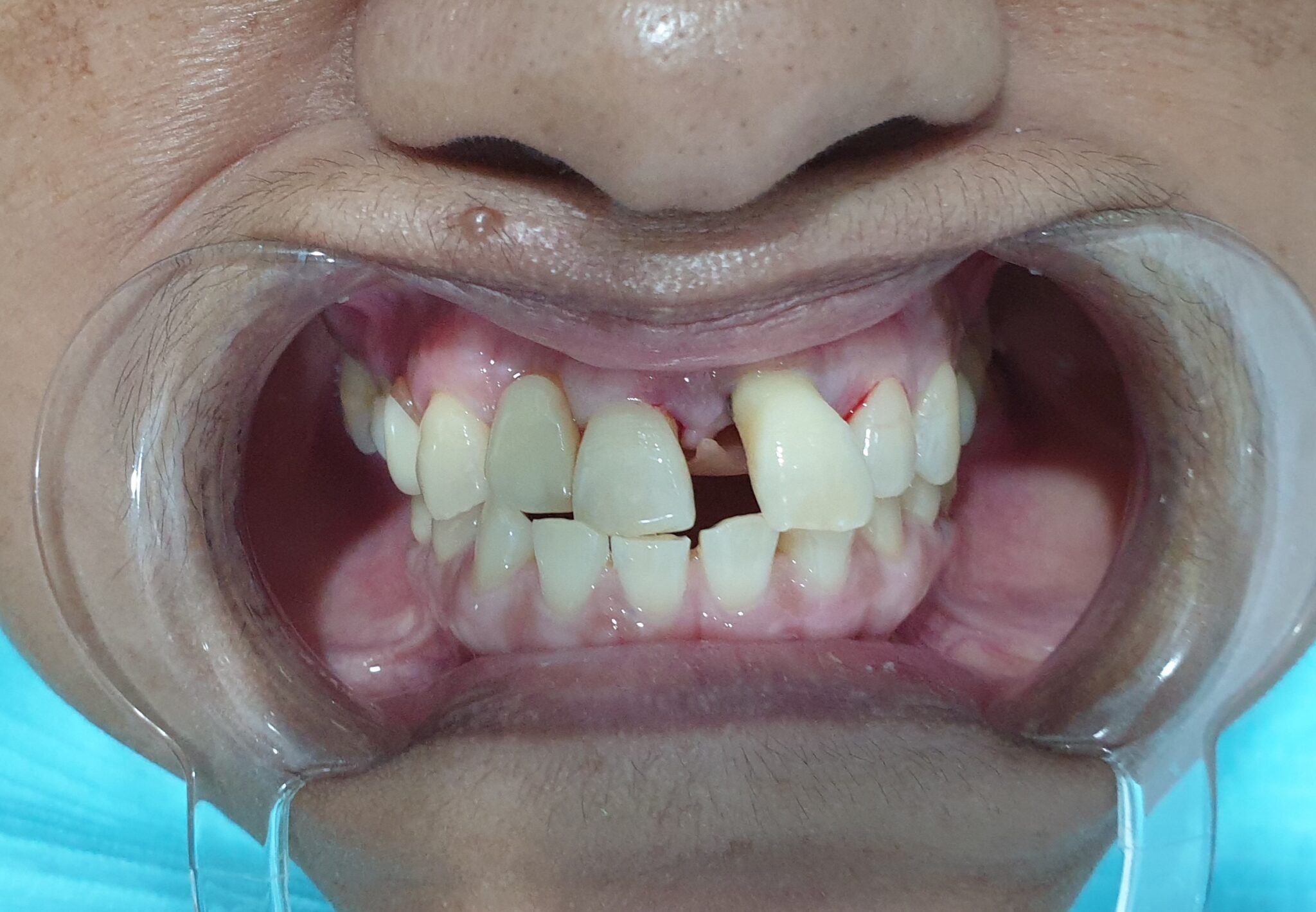 FRC bridge to the rescue: Dr Nik – Klinik Pergigian Fauziah