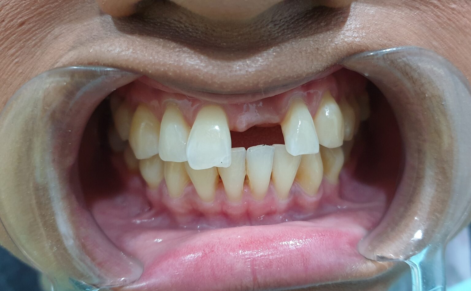 A change from a removable denture to a fixed FRC bridge: Dr Nik ...